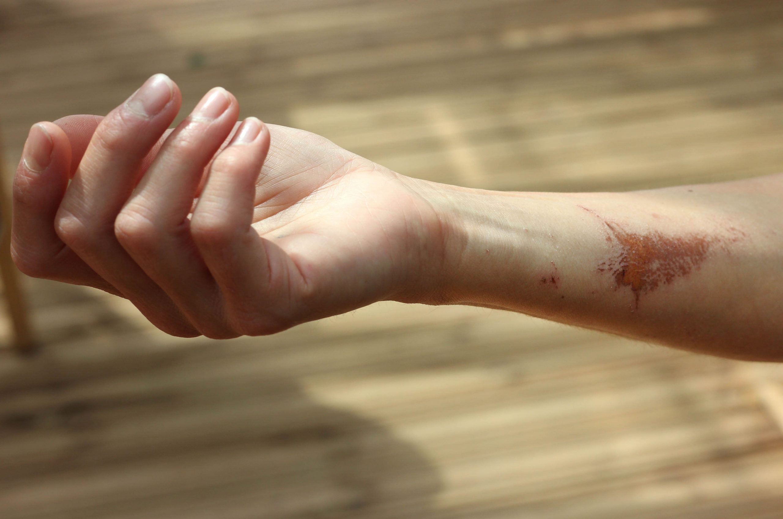 How To Remove Different Scars - HOTEL PATINOIRE